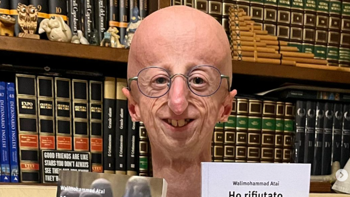 Mort de Sammy Basso : c’est quoi la progéria, cette maladie incurable aussi appelée « syndrome ...